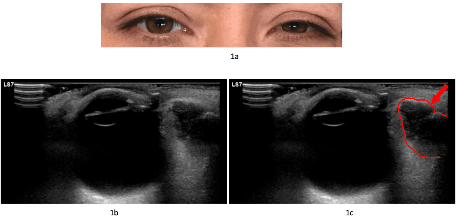 Cough Causing Abdominal Pain? A Rapid POCUS Diagnosis of Rectus Sheath Hematoma - POCUS Journal