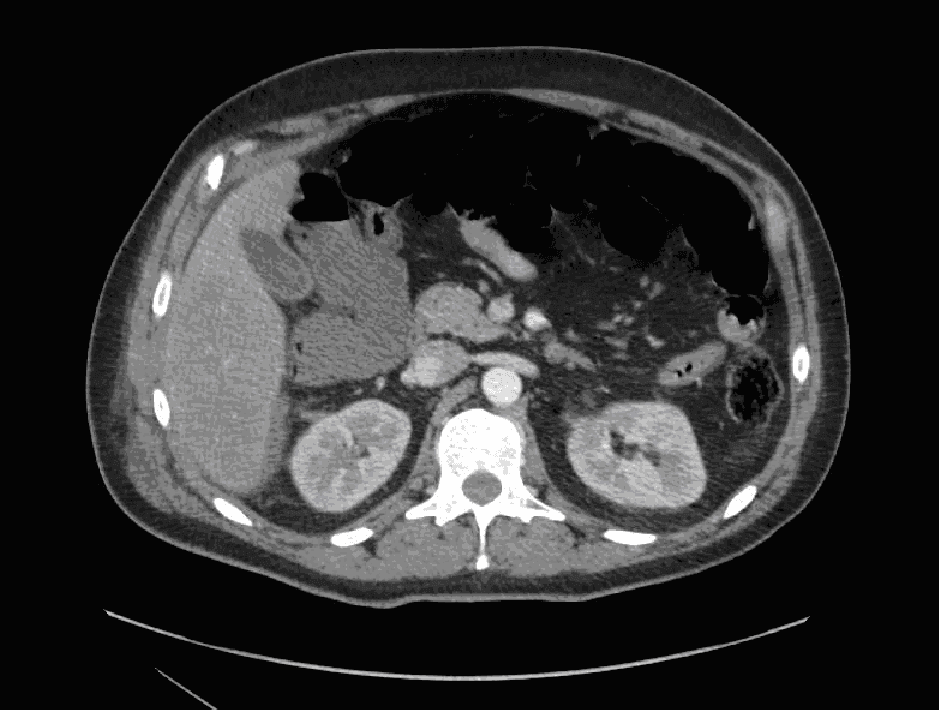 Case Report: FAST Ultrasound Interpretation in Trauma Resuscitation ...