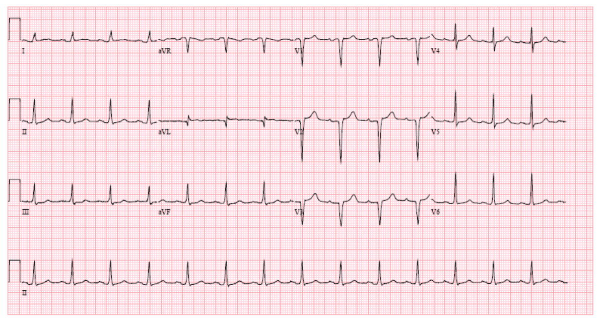 Case Report: Point of care ultrasound of a broken heart – POCUS Journal