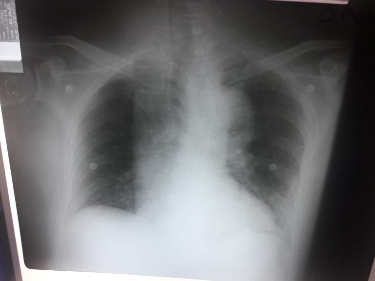 Two cases of aortic emergency presenting with neurologic manifestations ...
