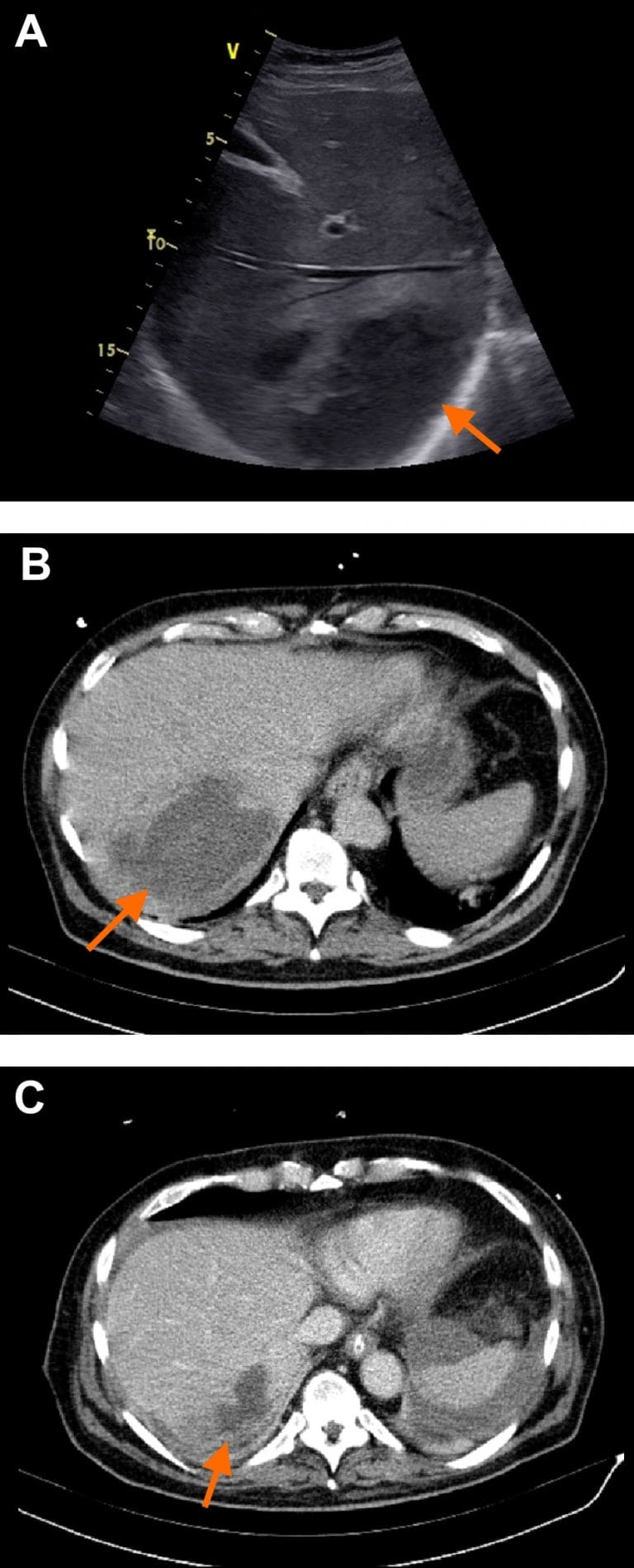 Shedding light on a hidden source of septic shock with POCUS - POCUS ...