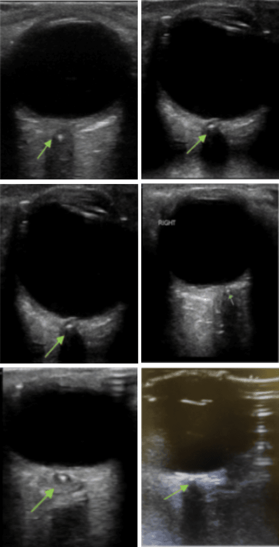 Diagnosis of Central Retinal Artery Occlusion in the Emergency ...