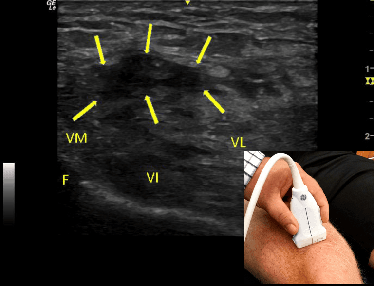 Ultrasound Imaging of Quadriceps Tendon in a Recreational Golfer ...