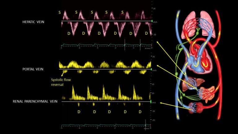 Evaluation of Venous Congestion Using Beside Ultrasonography by the ...