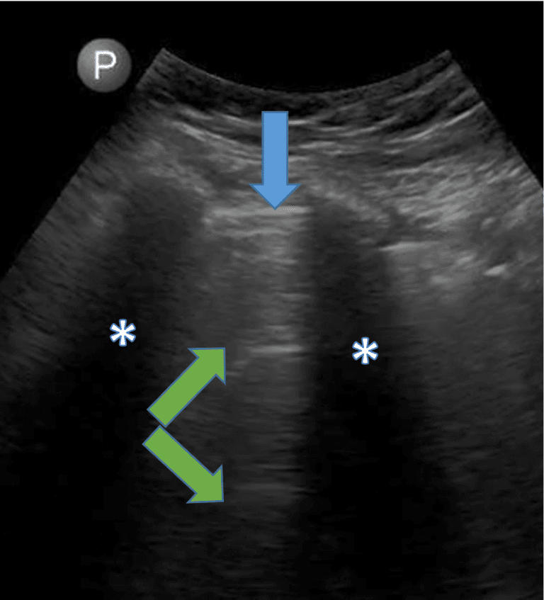 Rib Reverberation: An Important New Artifact in Lung Ultrasound - POCUS ...