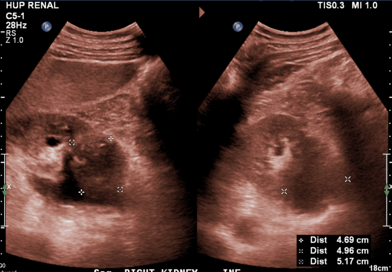 Vol 07 Kidney Issue - FEB 2022 Archives - POCUS Journal