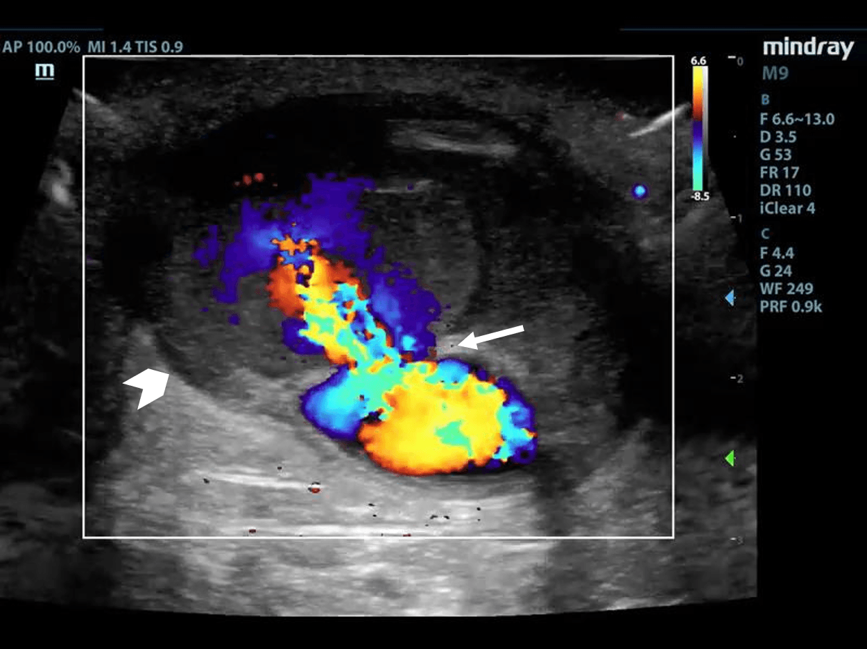 Point of Care Ultrasound Diagnosis of Pseudoaneurysm of an Upper ...