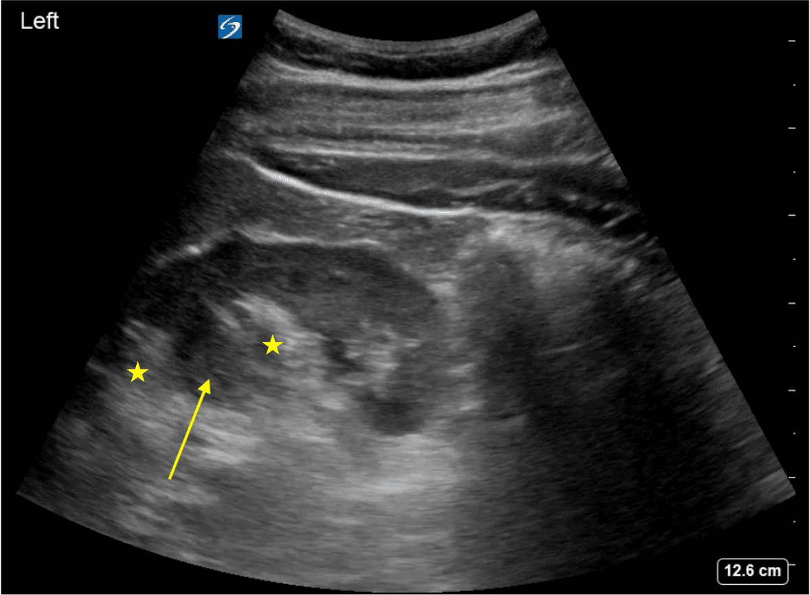 Bedside Assessment of the Kidneys and Bladder Using Point of Care ...