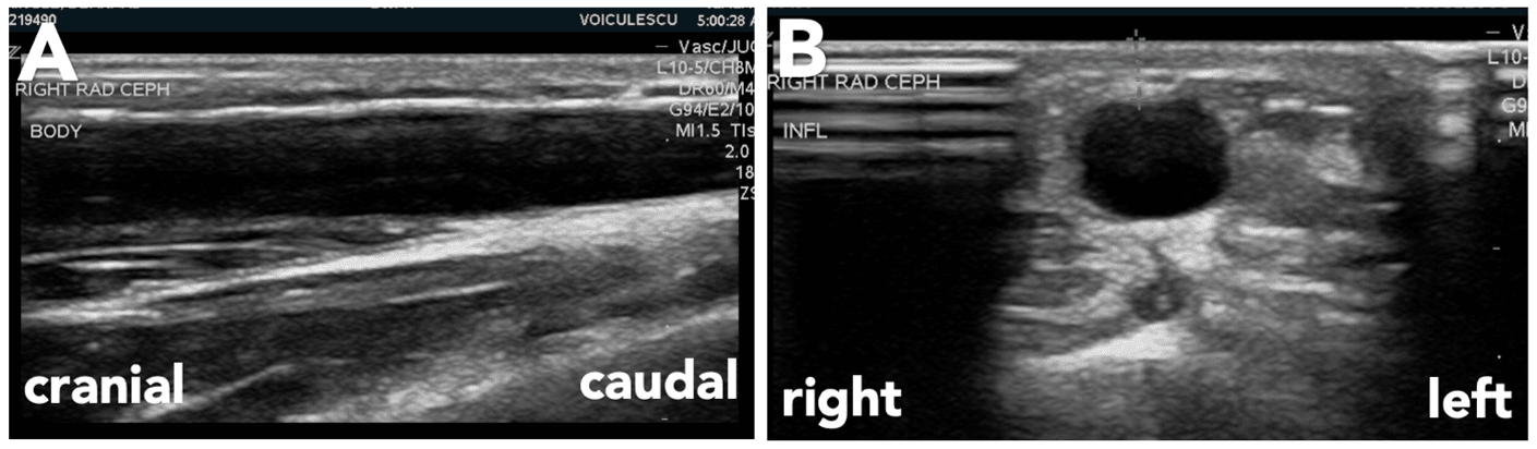 Point of Care Ultrasound of the Hemodialysis Vascular Access - POCUS ...