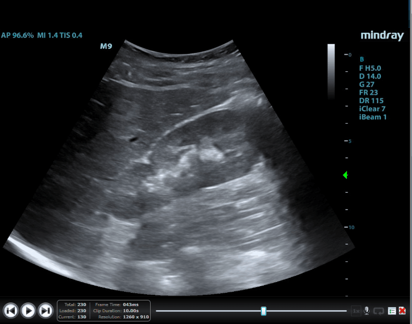 Figure 6 – Blau et al – POCUS Journal
