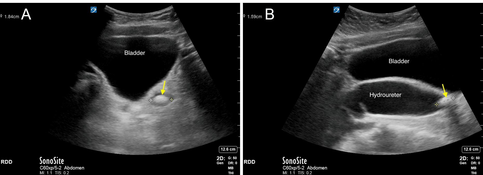 Bedside Assessment of the Kidneys and Bladder Using Point of Care ...