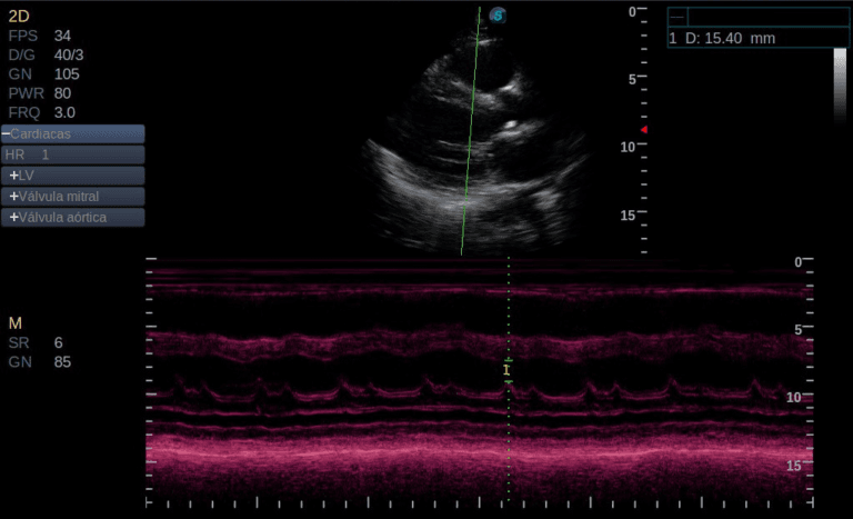 E-Point Septal Separation Accuracy for the Diagnosis of Mild and Severe ...