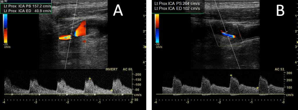 Pictorial Essay of Cervical Duplex Ultrasonography - POCUS Journal