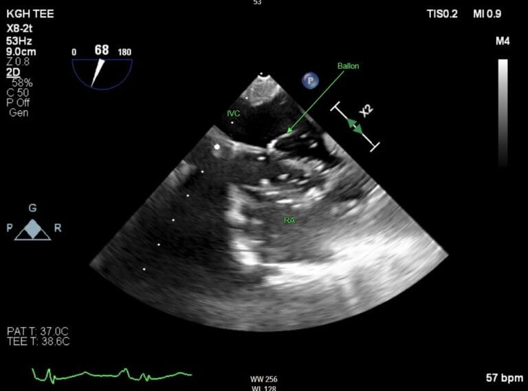 Transesophageal Echocardiography Guided Partial Right Atrial Inflow ...