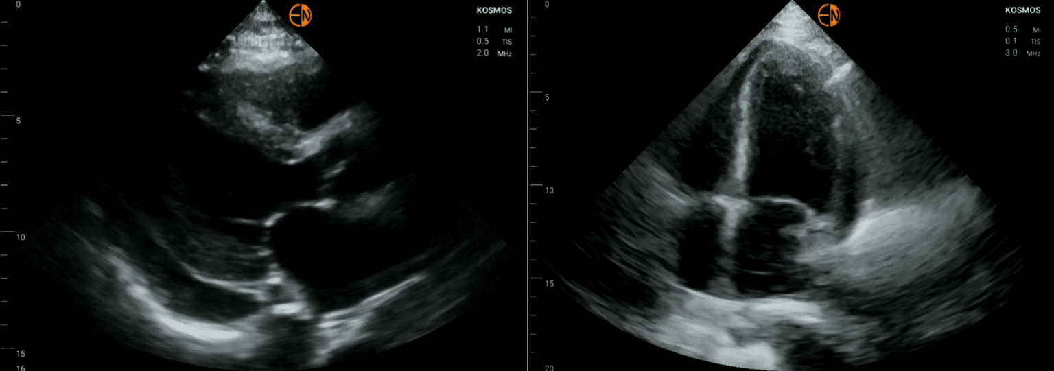 POCUS Finding of Portal Venous Gas: An Unusual Consequence of an ...