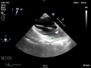 Transesophageal Echocardiography Guided Partial Right Atrial Inflow ...