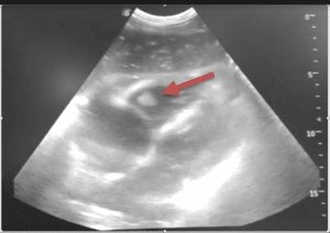 Three Cases of Right Heart Thrombus: Using POCUS for the Diagnosis of ...