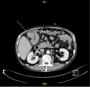Point-of-Care Ultrasound for the Diagnosis of Colon Cancer - POCUS Journal
