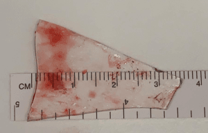 Ultrasound Diagnosis of a Retained Migrated Foreign Body Following ...