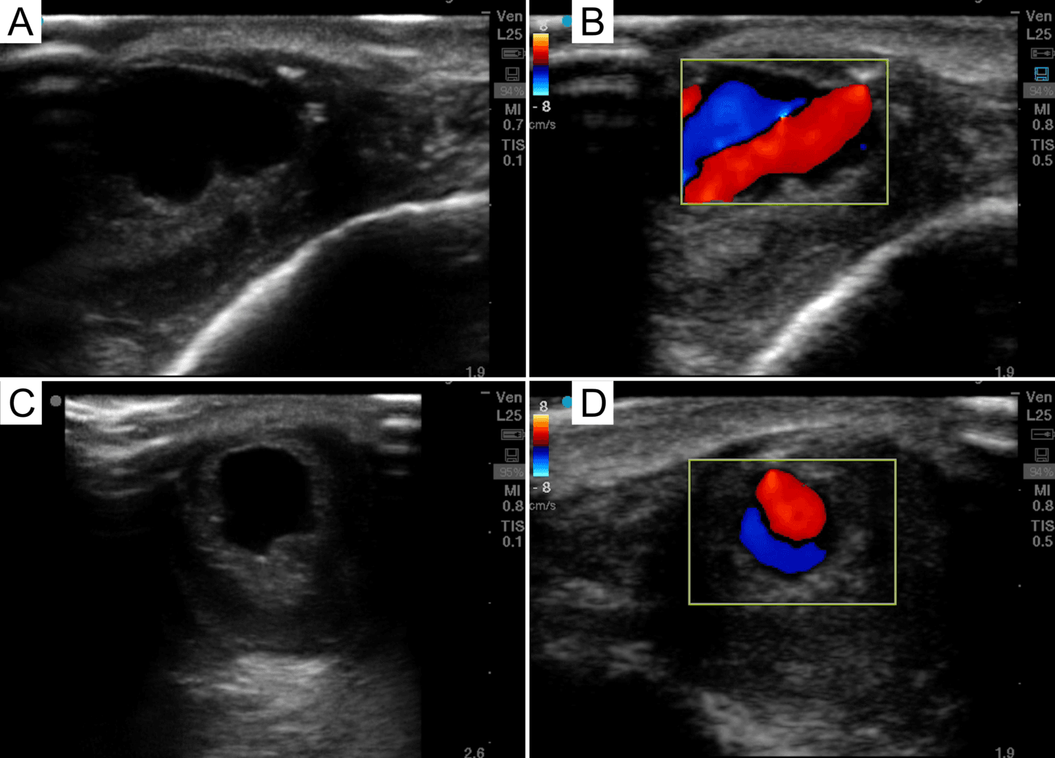 A Non-Resolving “Hematoma” Diagnosed as an Arteriovenous Malformation ...