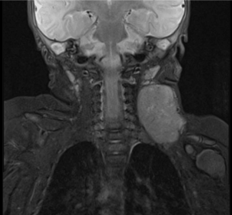 A Rare Cause of Neck Lump in an Infant - POCUS Journal