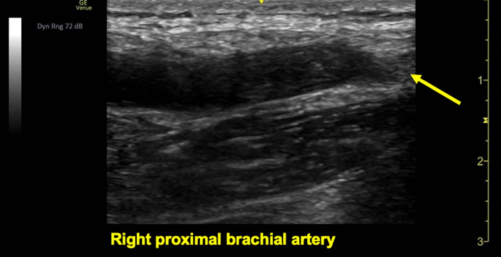 Acute Upper Extremity Arterial Occlusion Diagnosed on POCUS in the ...