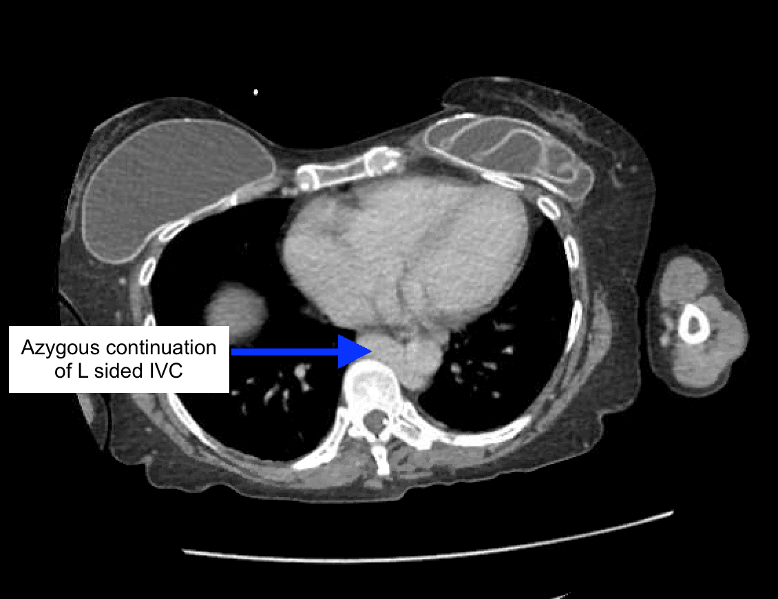 Missing Inferior Vena Cava on POCUS: A Case of Left-Sided IVC with ...