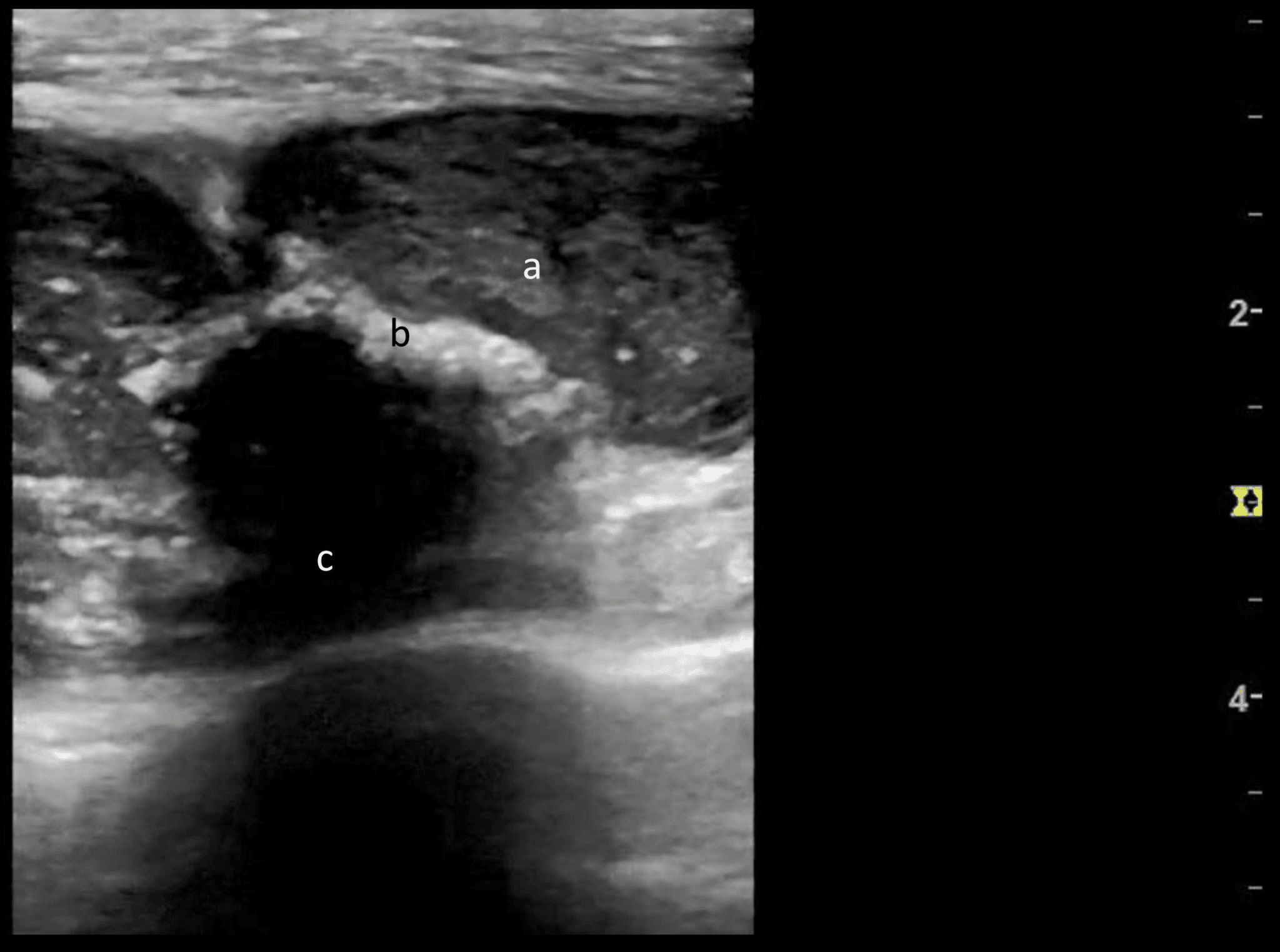 Sonographic Features of a Tuberculous Cold Abscess:A Case Report and ...