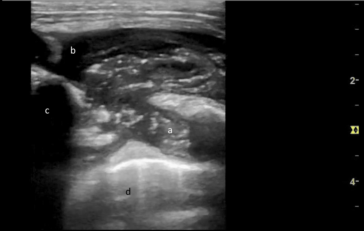 Sonographic Features of a Tuberculous Cold Abscess:A Case Report and ...