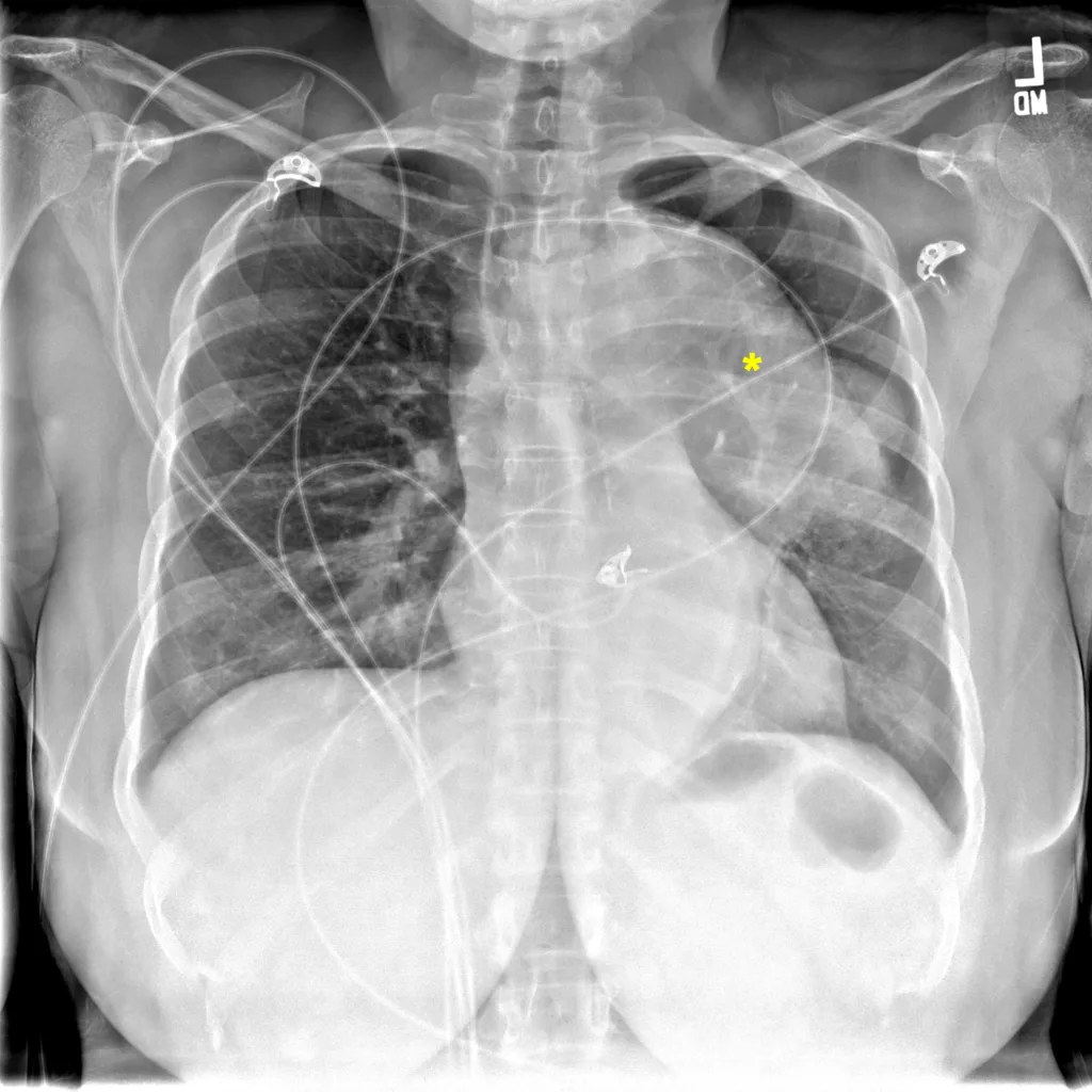 Abdominal Aortic Aneurysm Xray