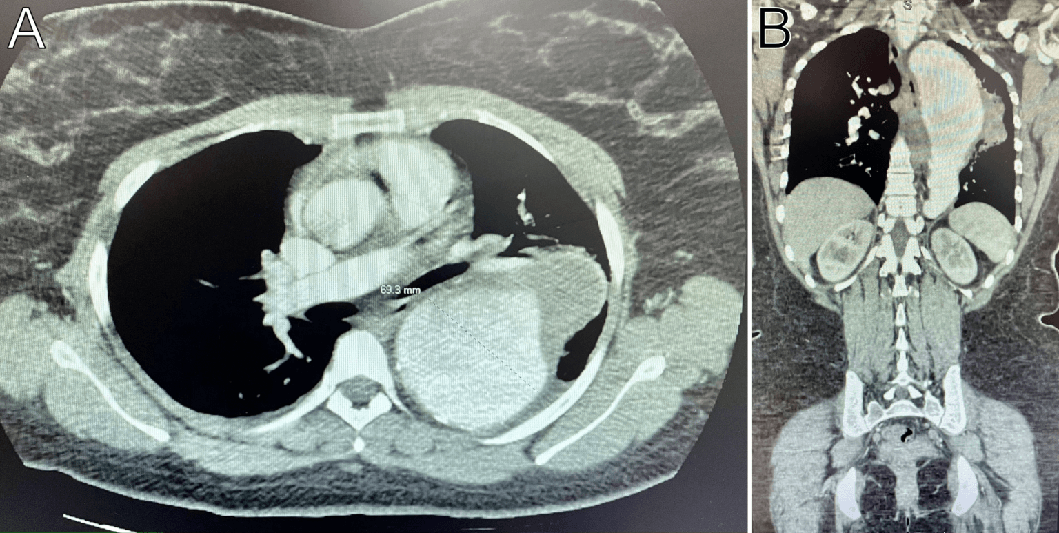 Thoracic Aortic Aneurysm Presenting as a Subacute Cough - POCUS Journal