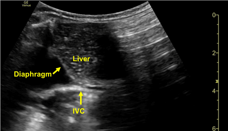 POCUS Confirmation of Intraosseous Line Placement: Visualization of ...