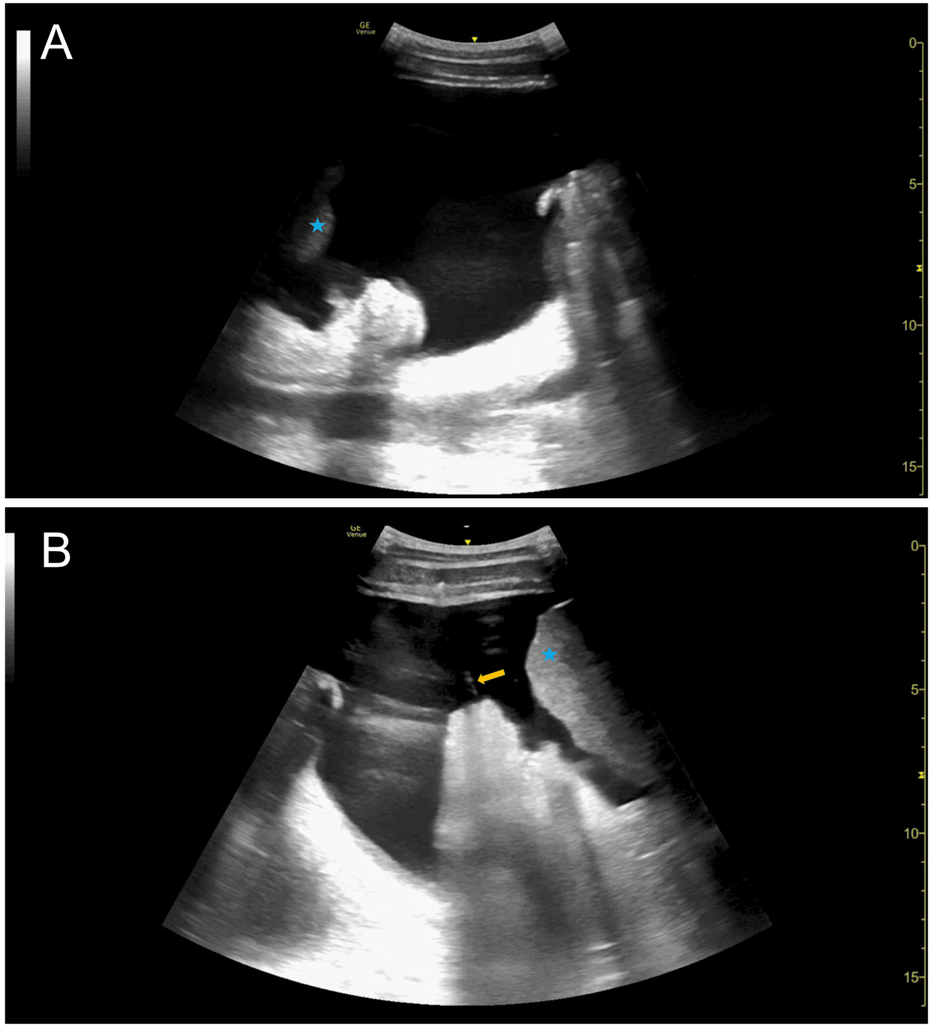 Troubleshooting Paracentesis Using POCUS - POCUS Journal