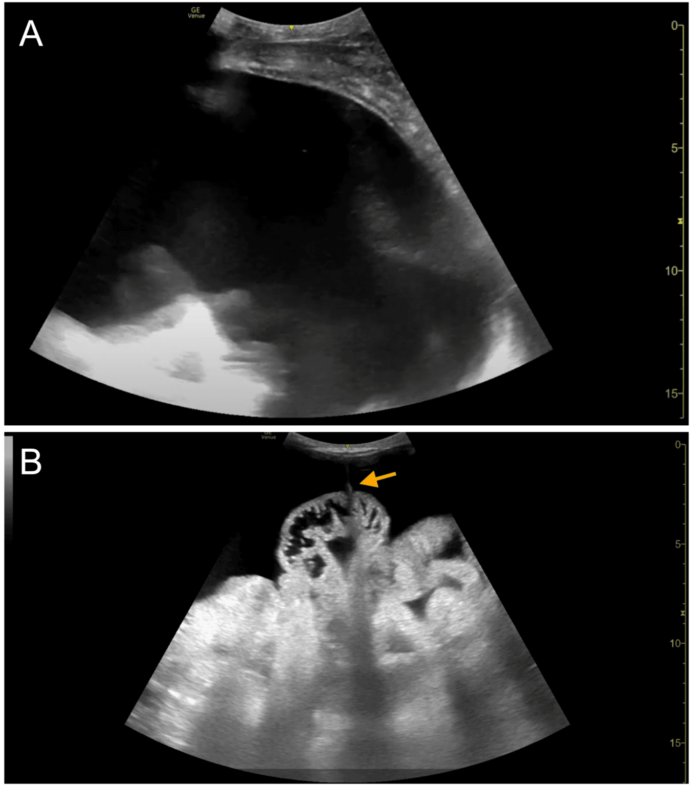 Troubleshooting Paracentesis Using POCUS – POCUS Journal