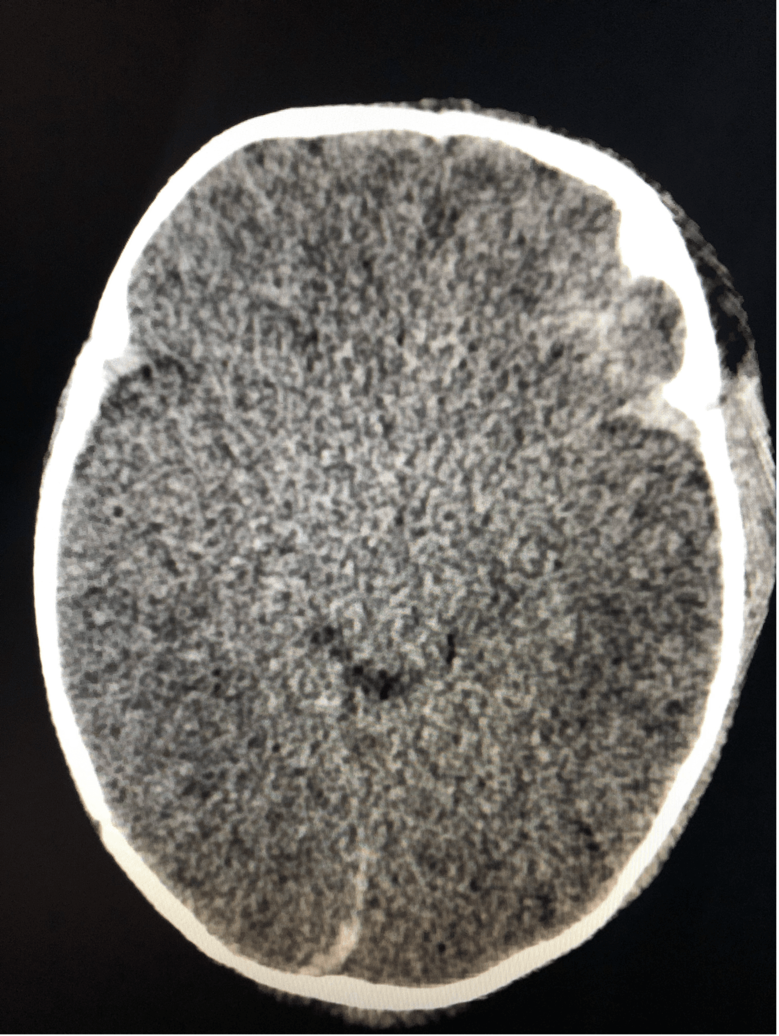 Brain Point of Care Ultrasound in Young Children Receiving Computed ...