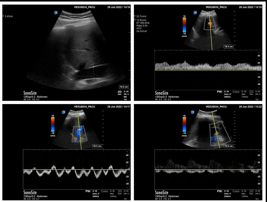 Integrative Volume Status Assessment - POCUS Journal