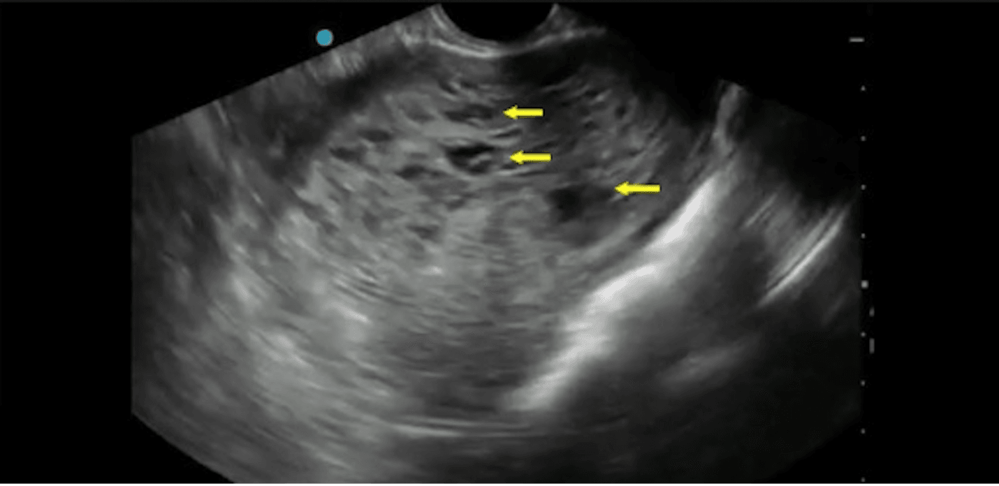 Vaginal Bleeding in a Peri-Menopausal Woman - POCUS Journal