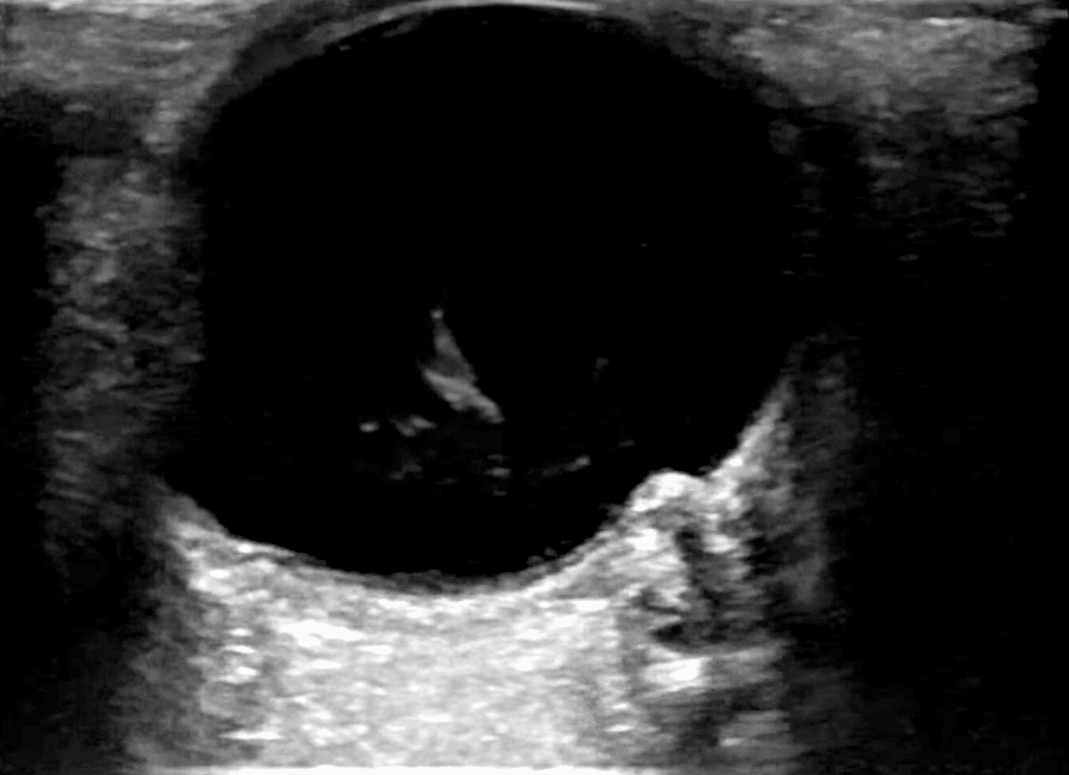 Terson Syndrome Diagnosed by Ocular Point of Care Ultrasound on the ...