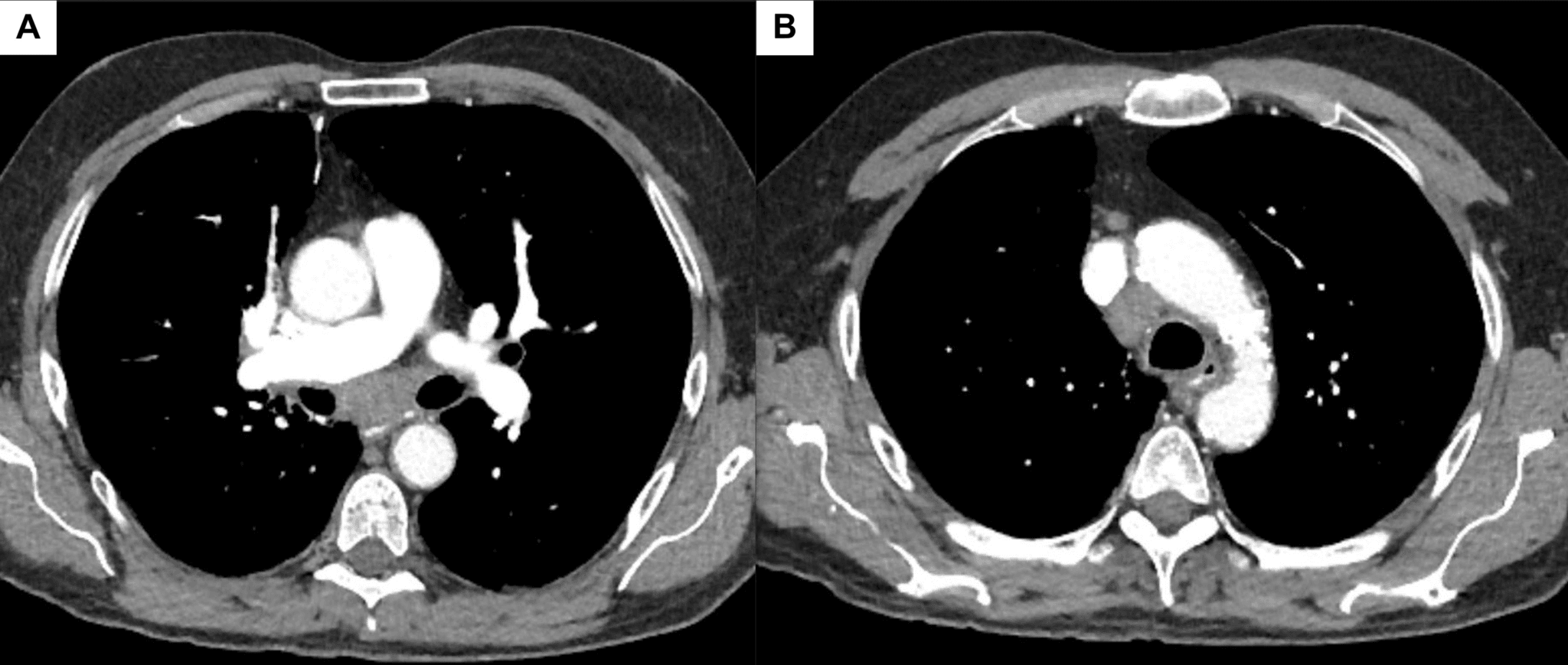 Point of Care Ultrasound Identification and Aspiration of a Neck Lymph ...
