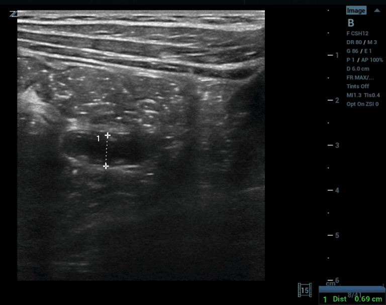Resolution of Sonographic Appendicitis in Pediatrics: a Point of Care Ultrasound Case-Series ...