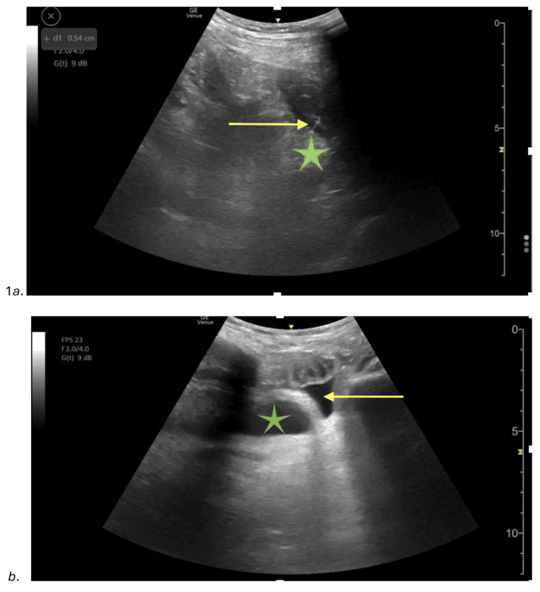 Return of the Living Dead Gut – A Case Report of Ischemic Colitis ...