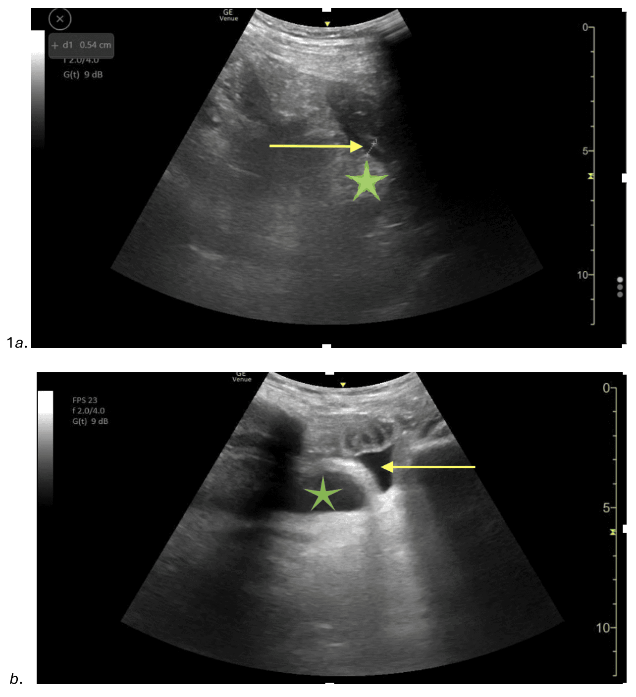 Return of the Living Dead Gut – A Case Report of Ischemic Colitis ...