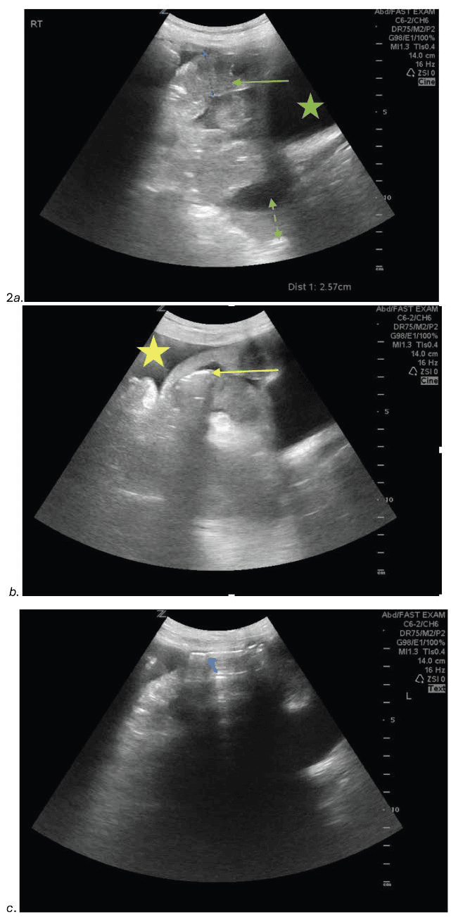 Return of the Living Dead Gut – A Case Report of Ischemic Colitis ...