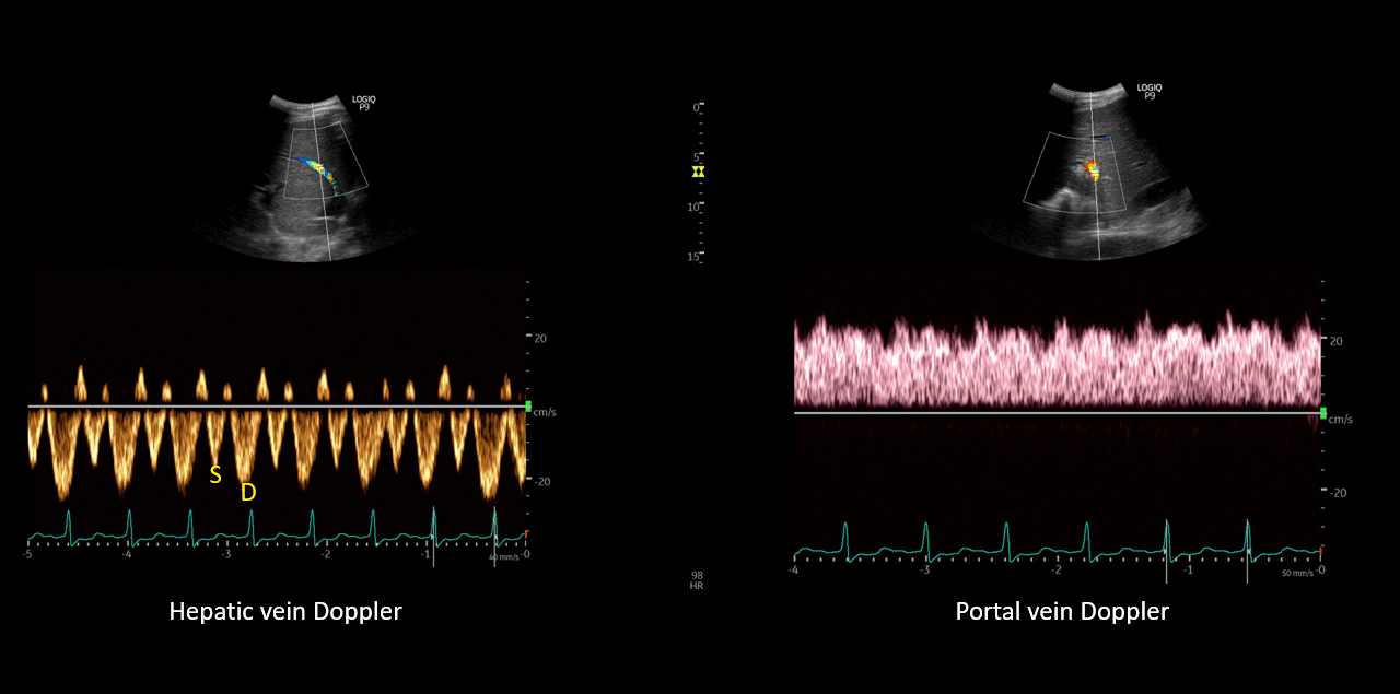 VExUS to Guide Ultrafiltration in Hemodialysis: Exploring a Novel ...