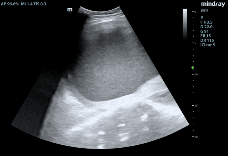 Hematometra: A Rare Case of Pelvic Pain in Females Identified with ...