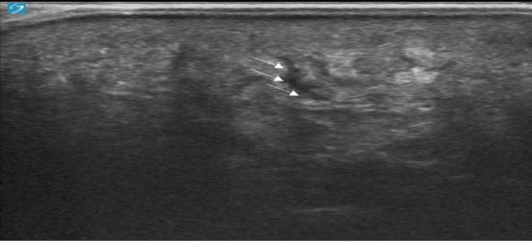 Diagnosis of Cutaneous Larva Migrans using Point of Care Ultrasound ...