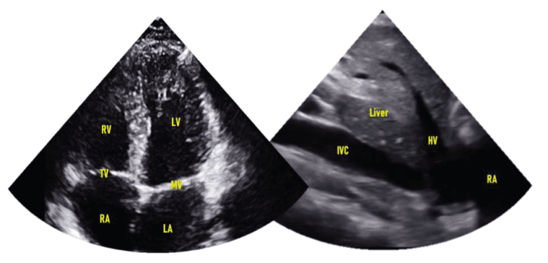 Integrative Volume Status Assessment - POCUS Journal
