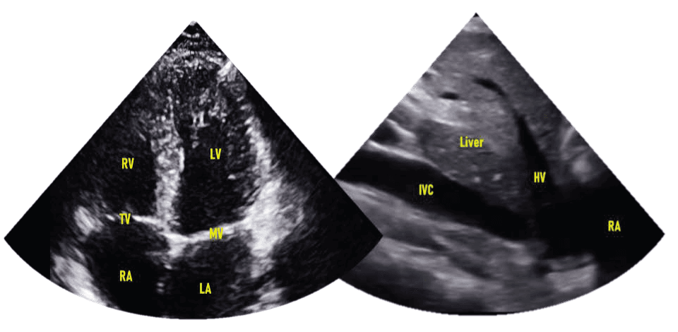 POCUS for Diastolic Dysfunction: A Review of the Literature - POCUS Journal