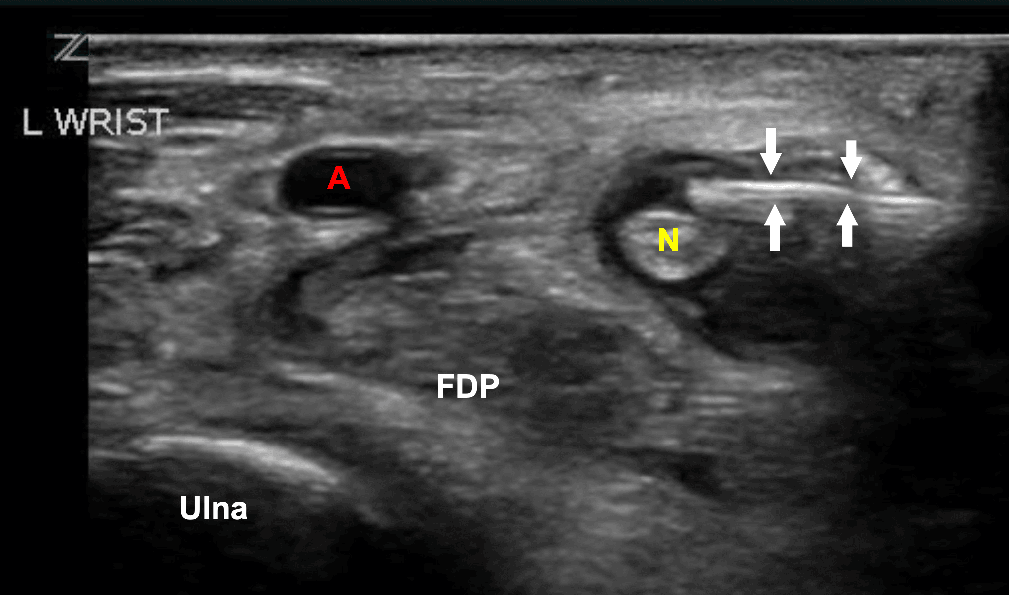 Ultrasound-Guided Nerve Blocks for Flexor Tenosynovitis - POCUS Journal