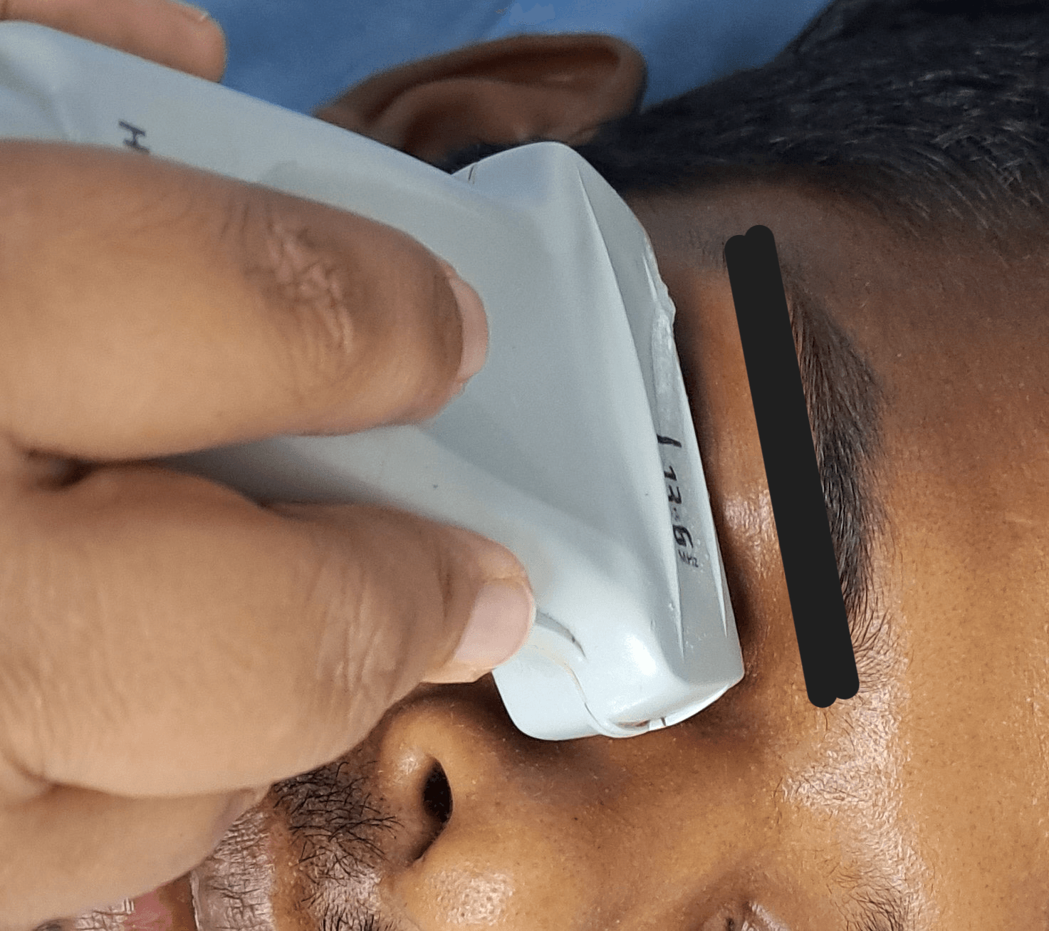 Correlation of Point of Care Ultrasound (POCUS) Guided Pupillary ...